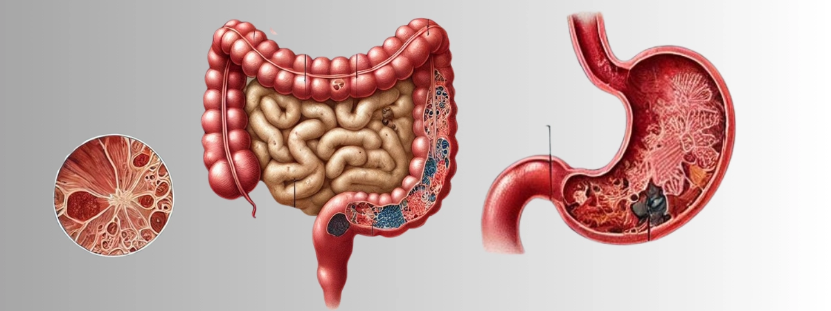 Best Necrotizing Enterocolitis Treatment In Chennai